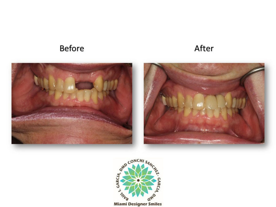 Porcelain Restorations | Porcelain Dental Inlays/ Onlays | Miami ...