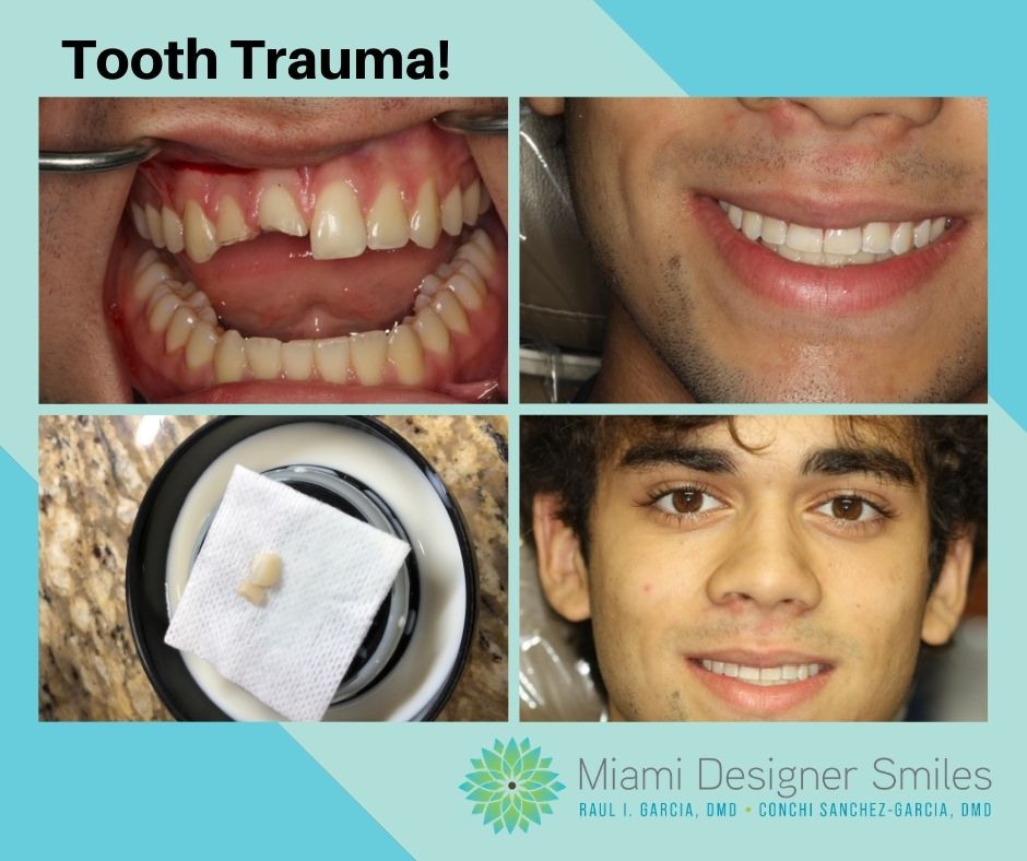 Tooth Trauma | Dental Trauma